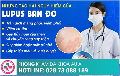 Cách trị lupus ban đỏ hiệu quả, nhanh khỏi